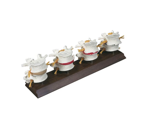 Köp 3B Modell DEGENERATIVA RYGGKOTOR